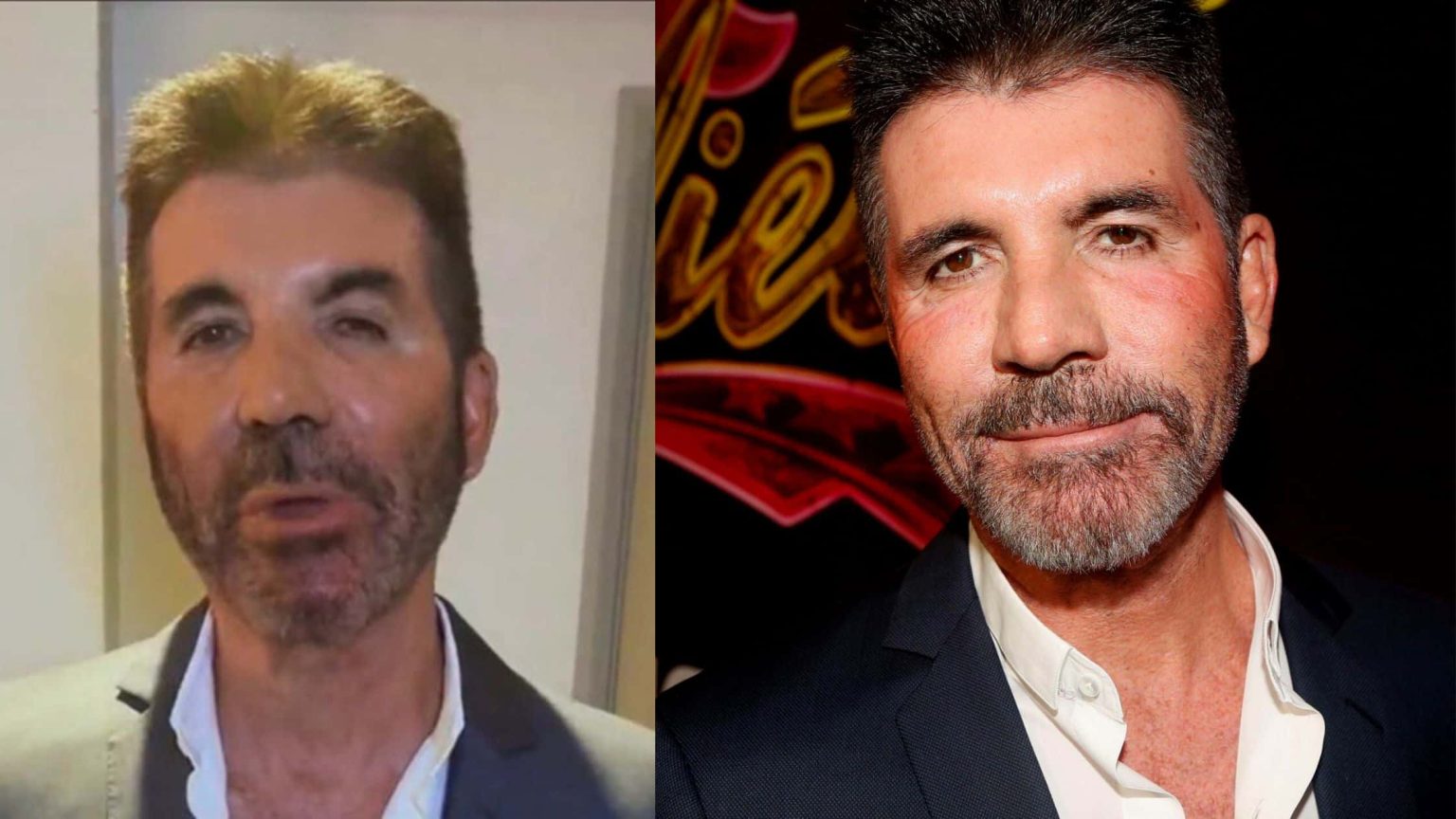 "There is no filler in my face at all now": Simon Cowell Regretted ...